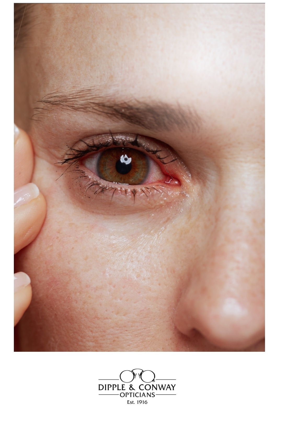 How to treat dry eyes disease - Dipple and Conway